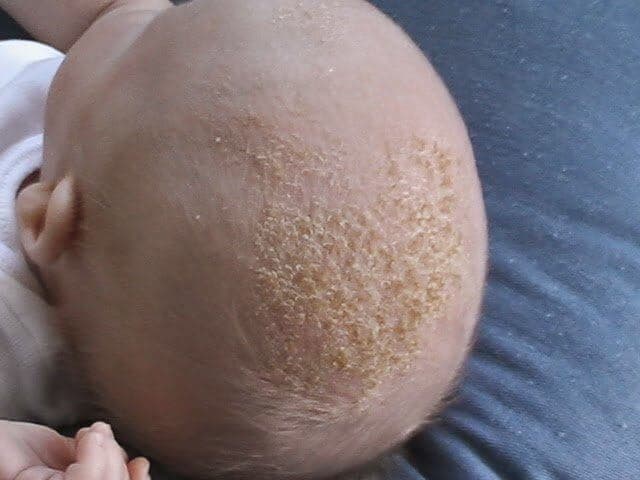 Baby Rash Decoder: What is This?